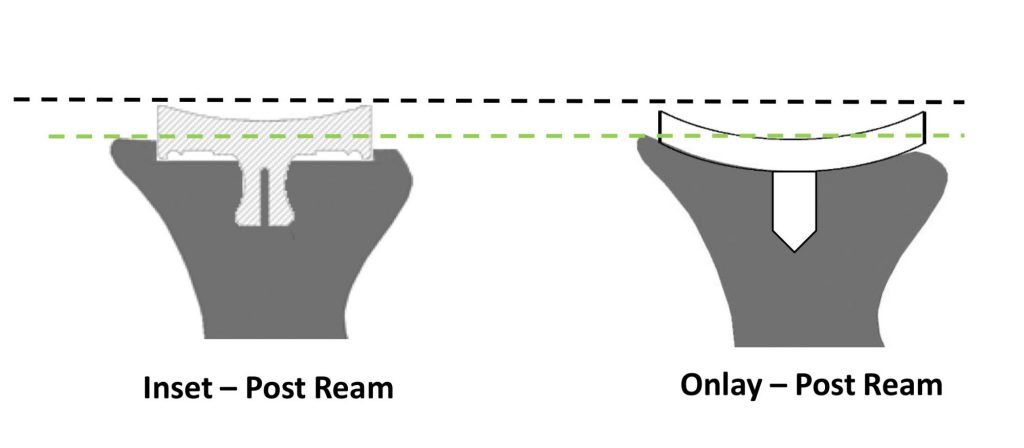Humeral Stem Shoulder Innovations