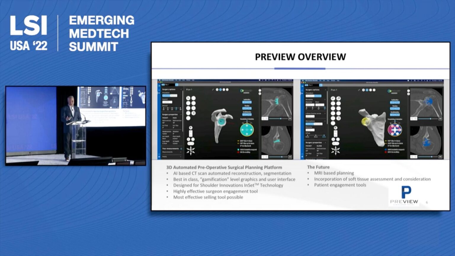 Shoulder Innovations | InSet™ Shoulder Implants