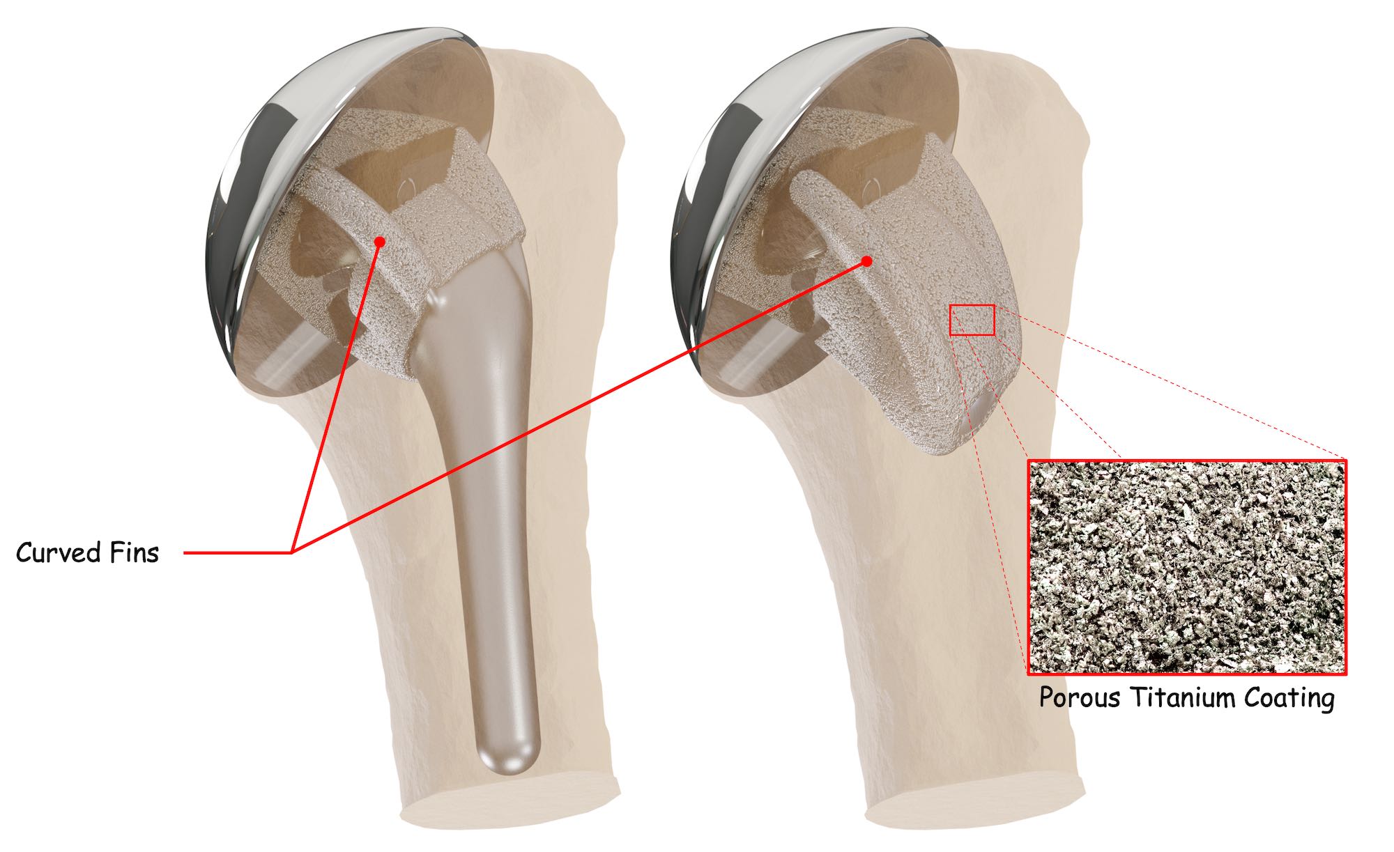 Total Shoulder Replacement Surgery - Shoulder Innovations