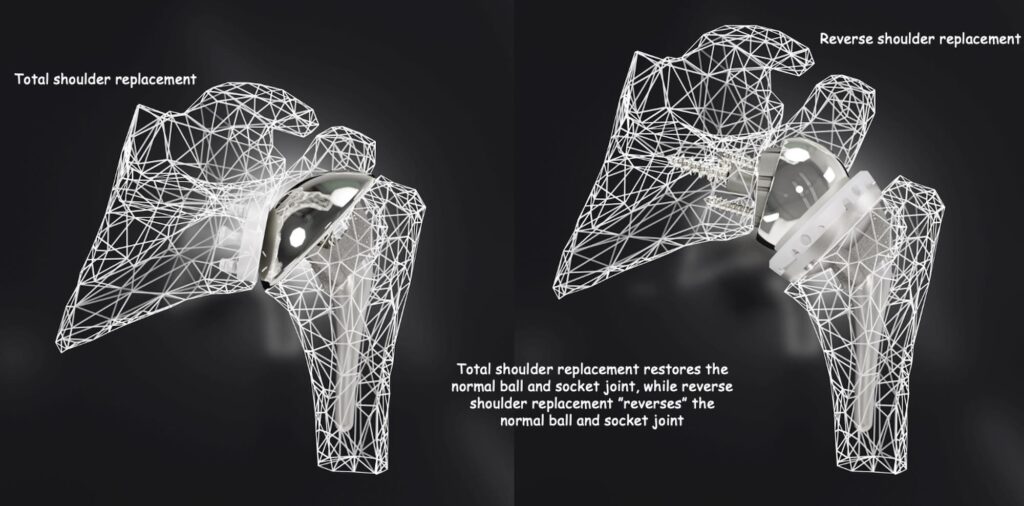 Reverse Shoulder Replacement - Shoulder Innovations