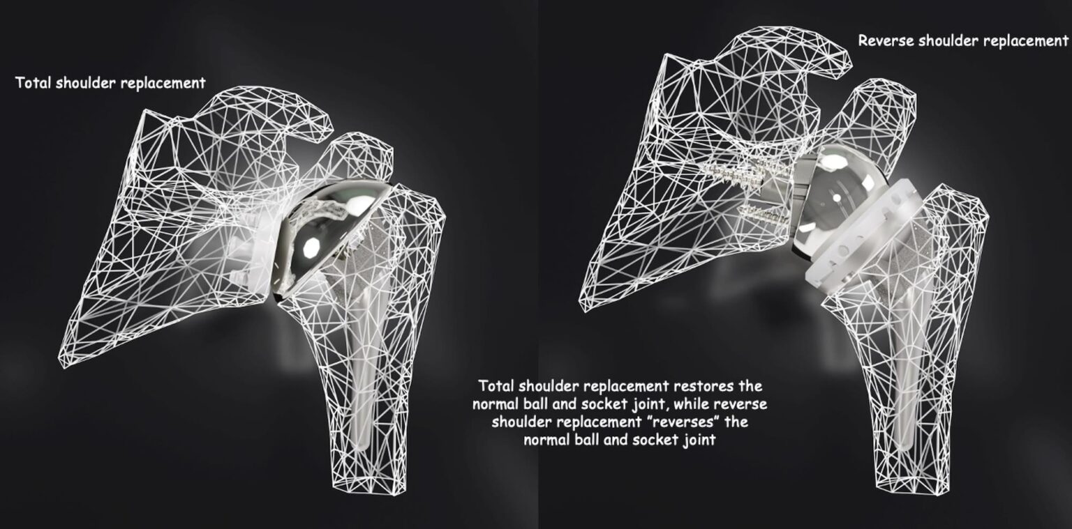 Reverse Shoulder Replacement - Shoulder Innovations