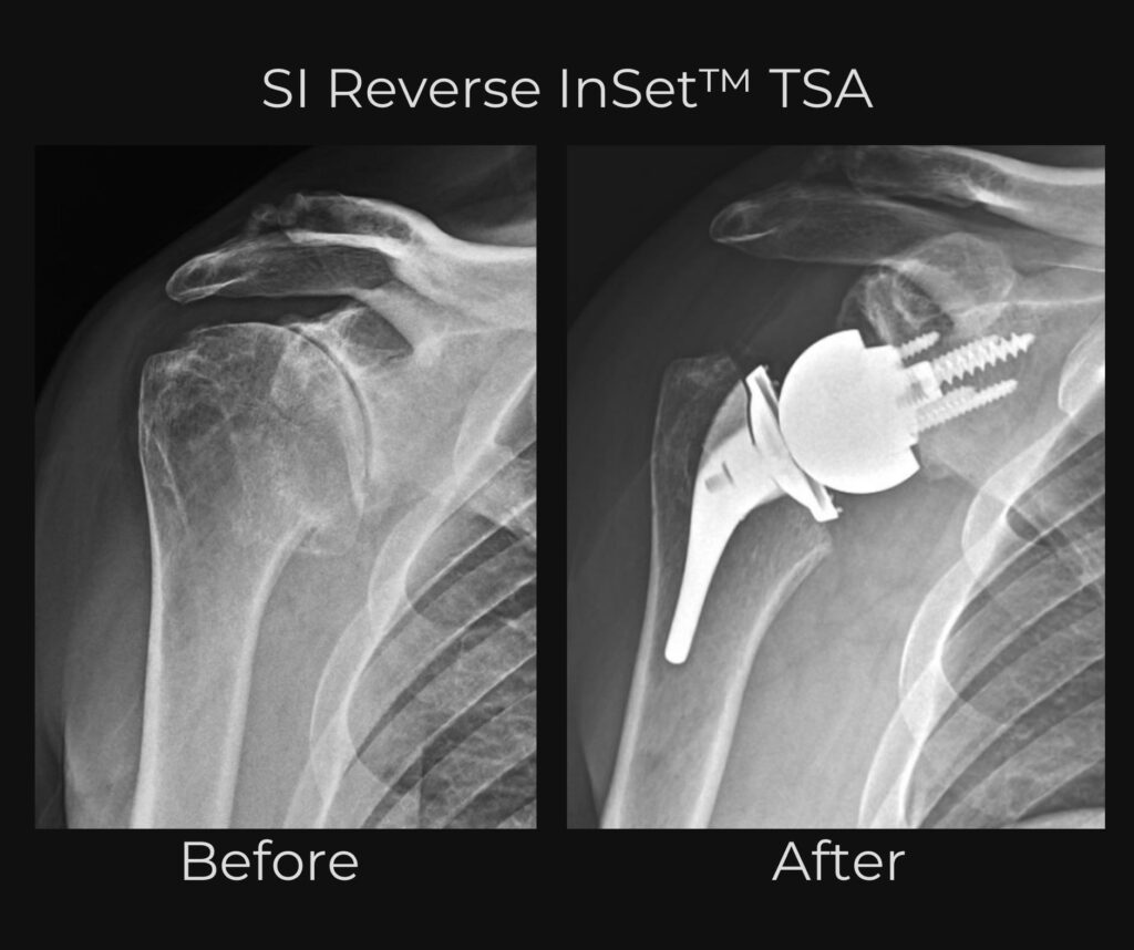 Interview with Dr. Ryan Churchill, MD - Shoulder Innovations
