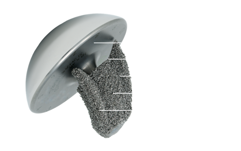 InSet® Stemless Shoulder Replacement System