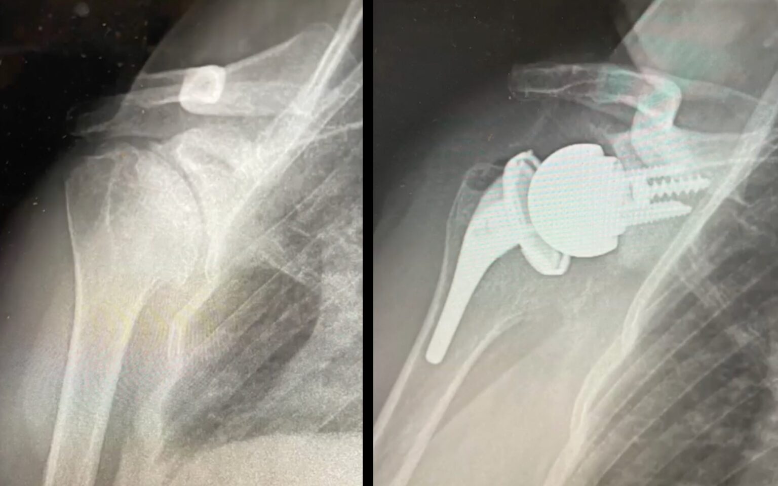 Dr. Chris Chuinard Reverse Shoulder Replacement Surgery Video