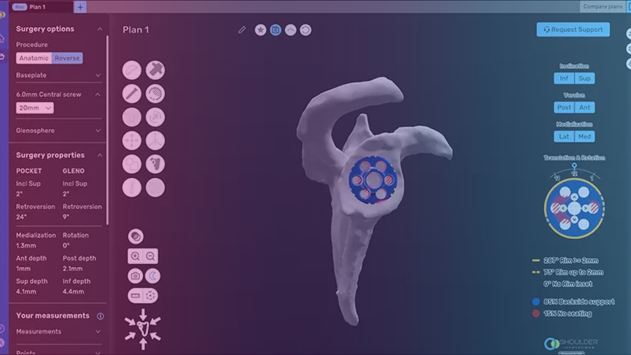 ProVoyance® Shoulder - Shoulder Surgery Planning Software