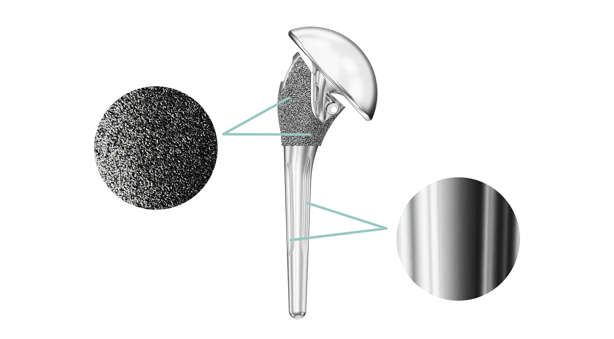 InSet® 95 Humeral Stem - Shoulder Innovations