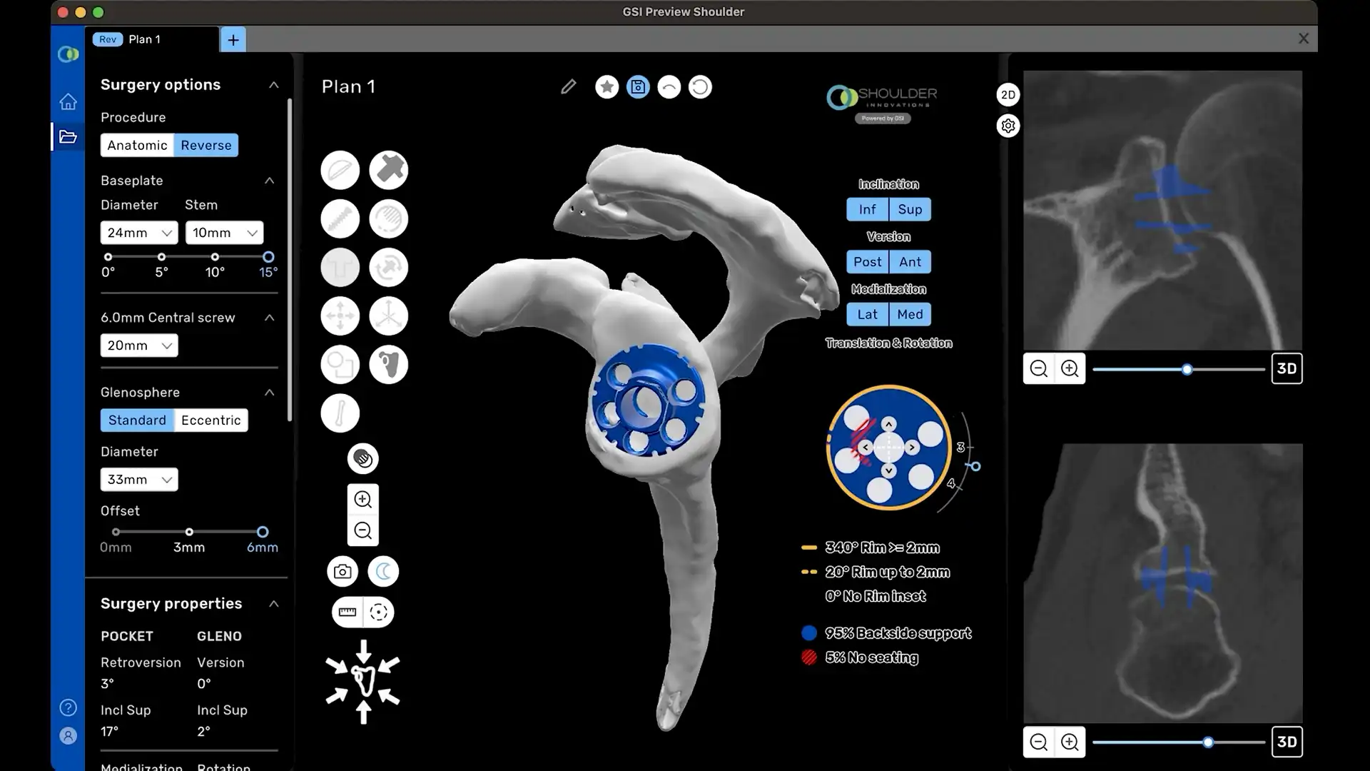 InSet™ Reverse Shoulder System