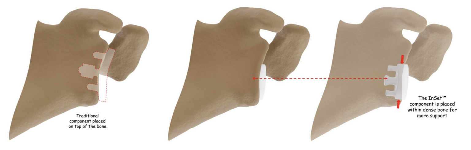 Total Shoulder Replacement Surgery - Shoulder Innovations