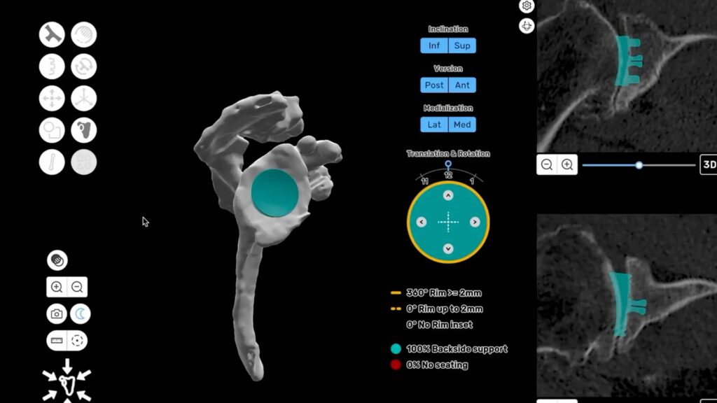 ProVoyance® Shoulder - Shoulder Surgery Planning Software